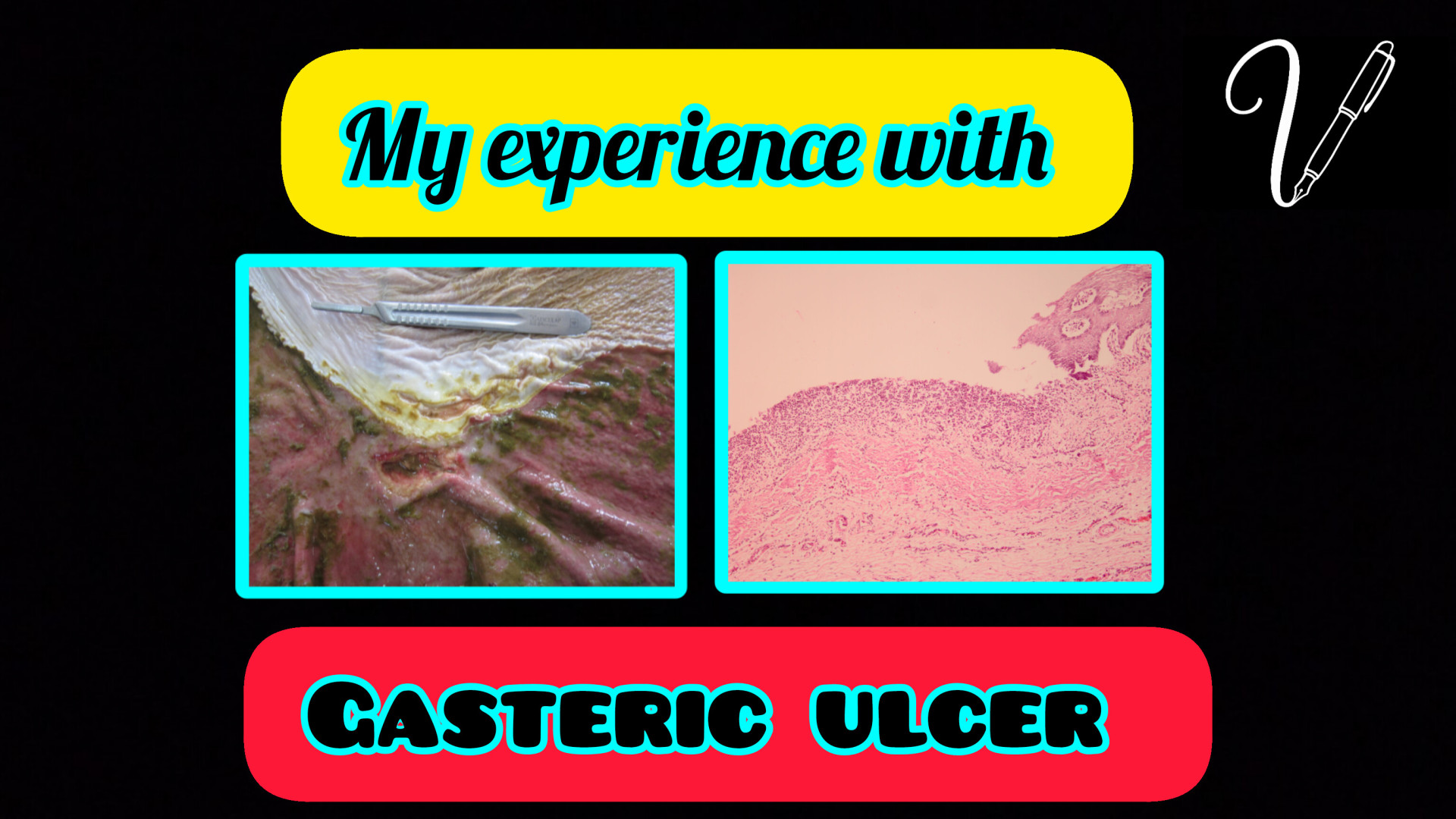 زخم معده (Gasteric ulcer)