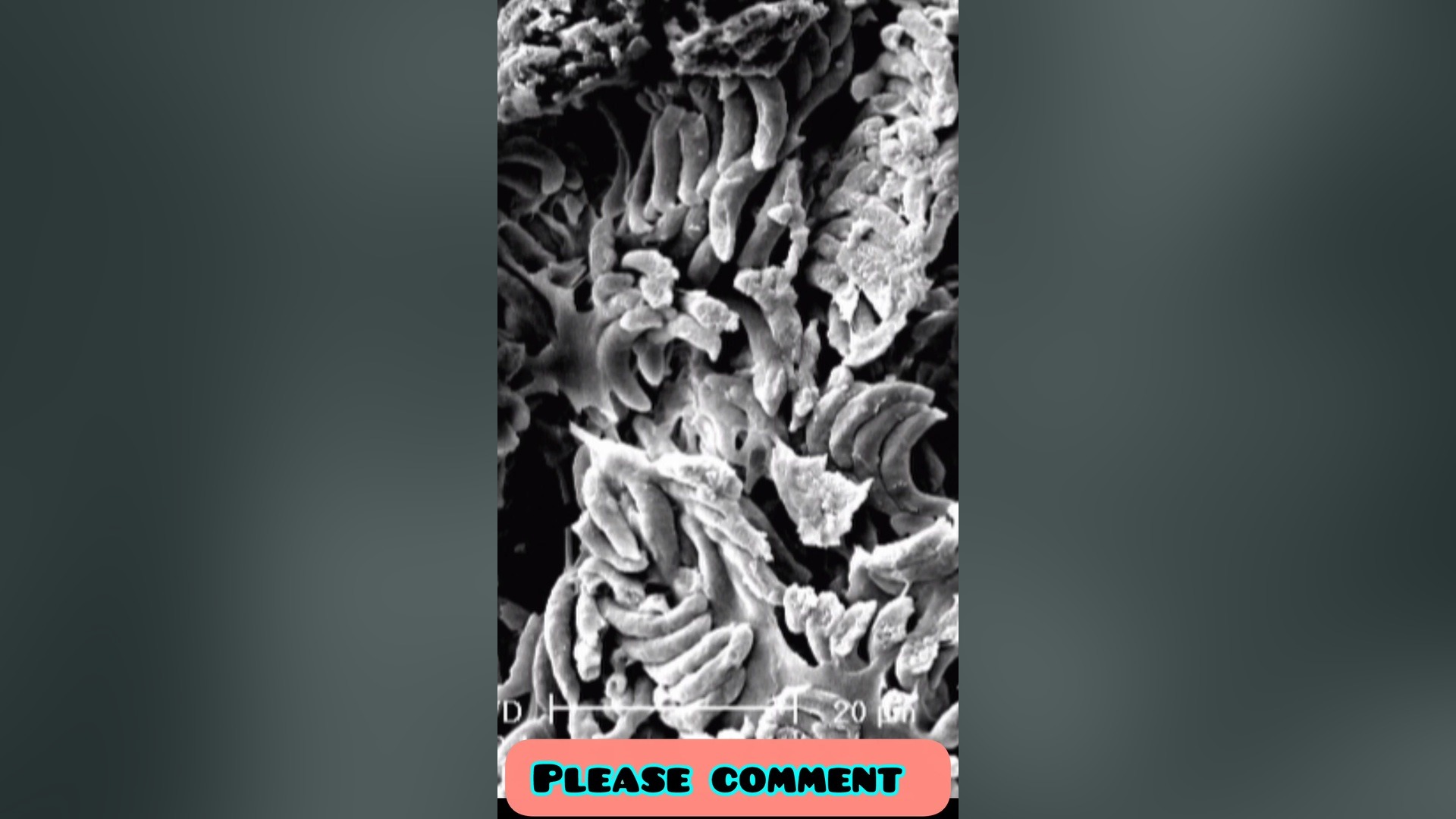 زخم معده (Gasteric ulcer)