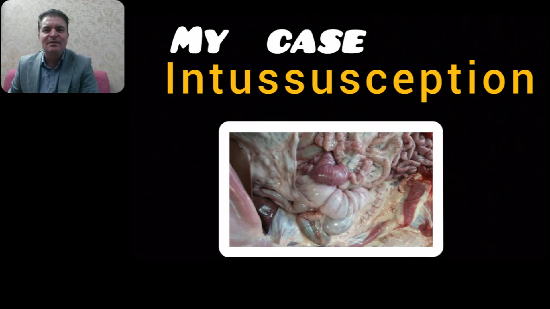 زخم معده (Gasteric ulcer)