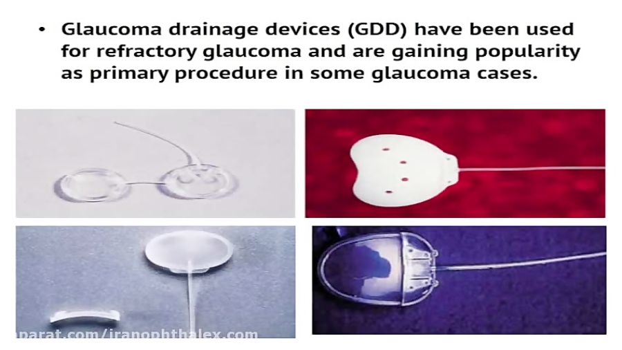 Glaucoma Drainage Device Surgery, Session Two
