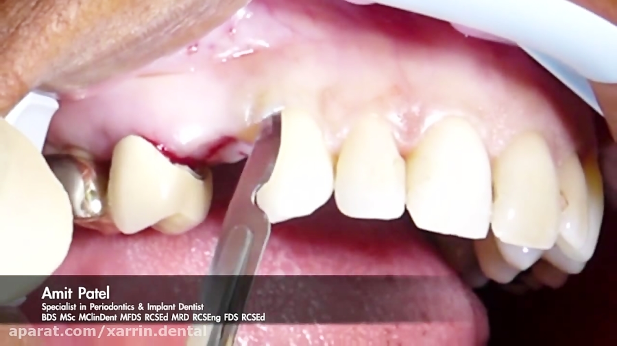 One-stage surgery using Tapered Internal PLUS implant