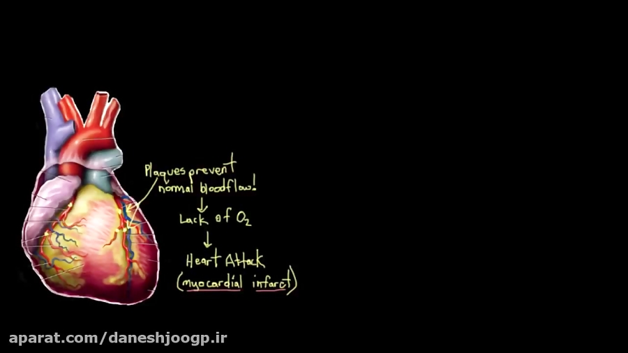 Heart attack (myocardial infarction) pathophysiology | NCLEX-RN | Khan ...