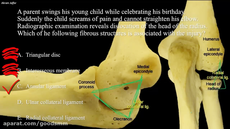 Anatomy of a pulled elbow