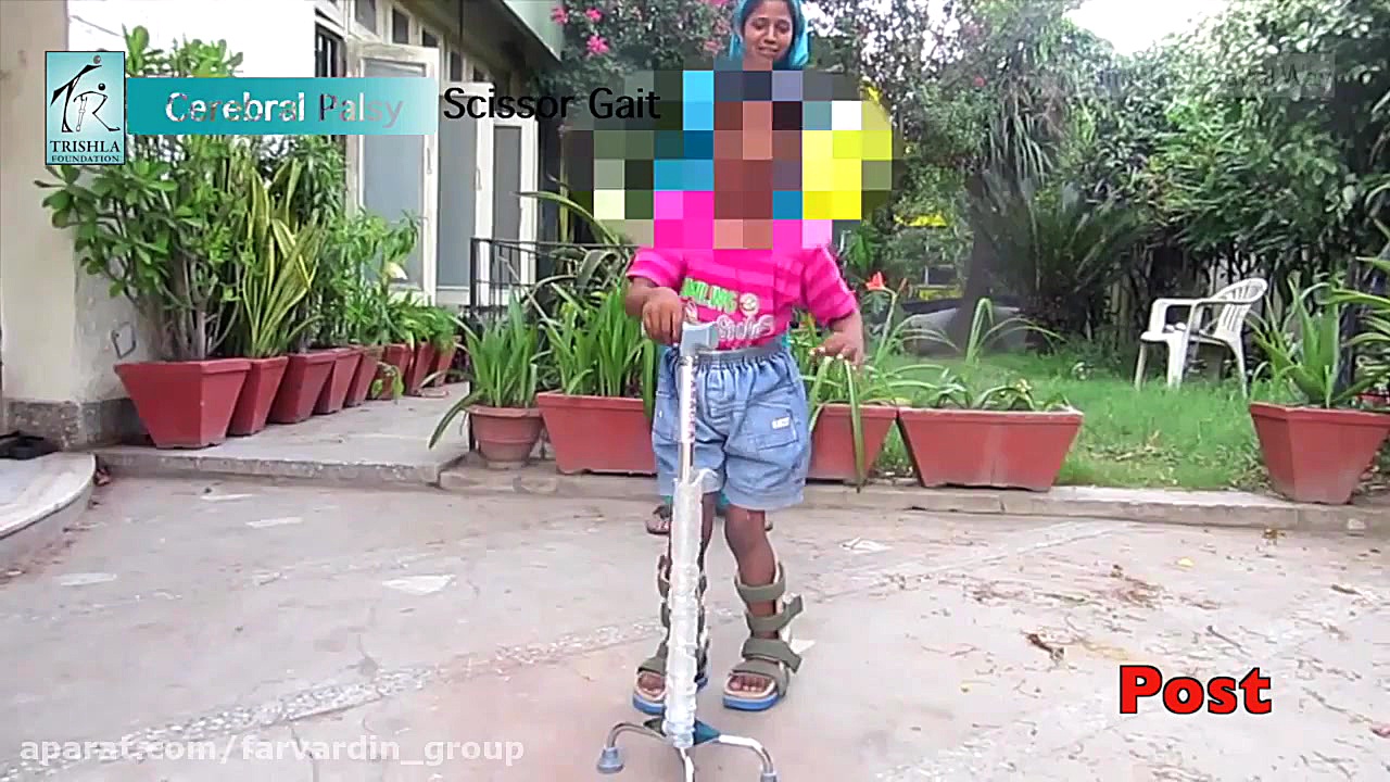 Scissor gait cerebral palsy management